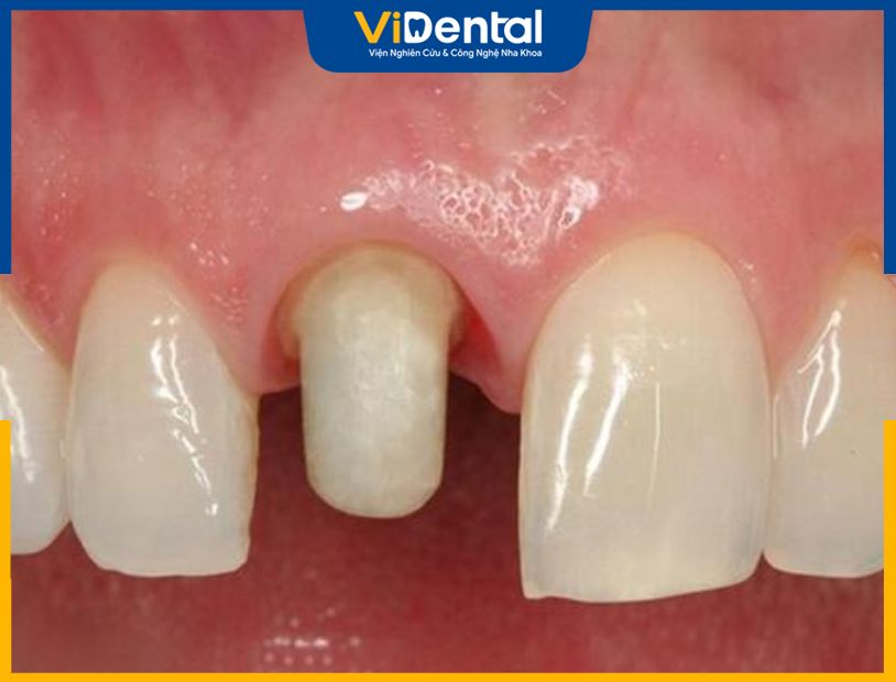 Răng Bọc Sứ Bị Viêm Tủy Do Đâu Và Cách Xử Lý Như Thế Nào?