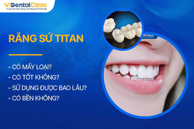 Răng Sứ Titan Là Gì? Răng Sứ Titan Có Mấy Loại?