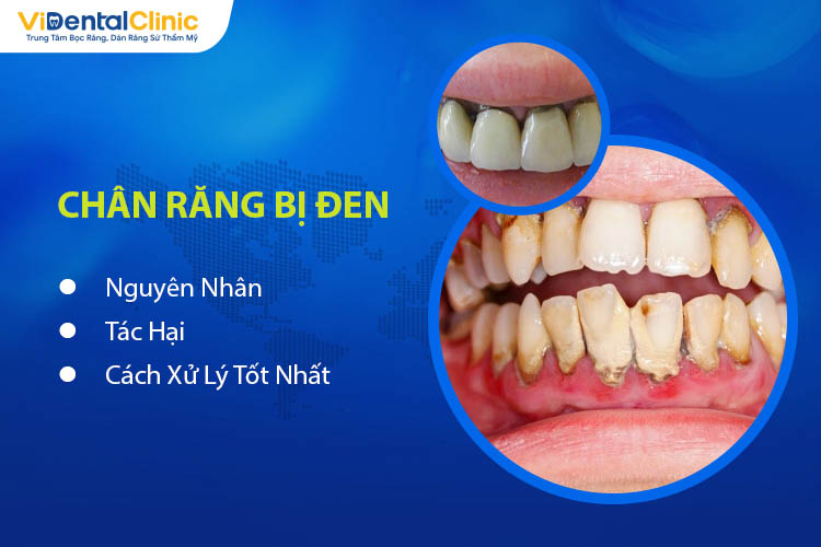 Chụp X-quang Răng: Tác Dụng, Quy Trình Và Lưu Ý Quan Trọng