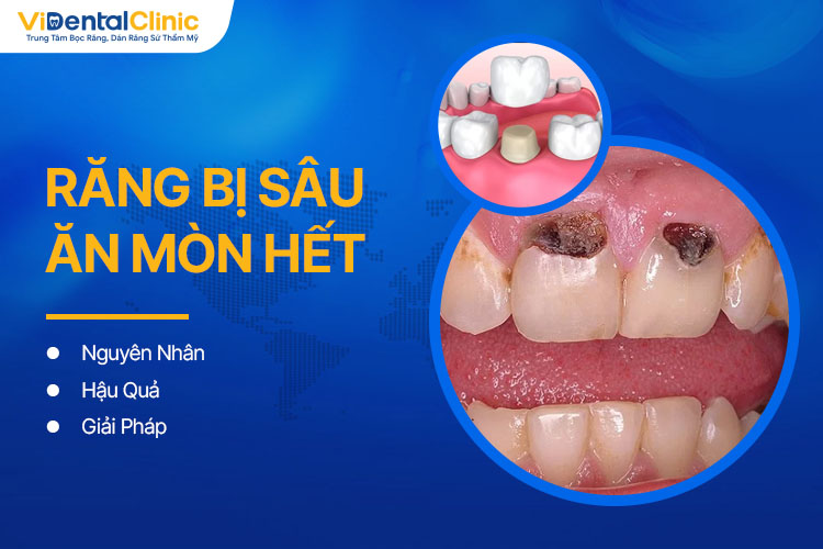 Nguyên Nhân Răng Bị Sâu Ăn Mòn Hết Là Gì? Giải Pháp