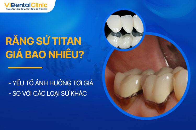 Răng Sứ Titan Giá Bao Nhiêu? Bảng Giá Chi Tiết Nhất